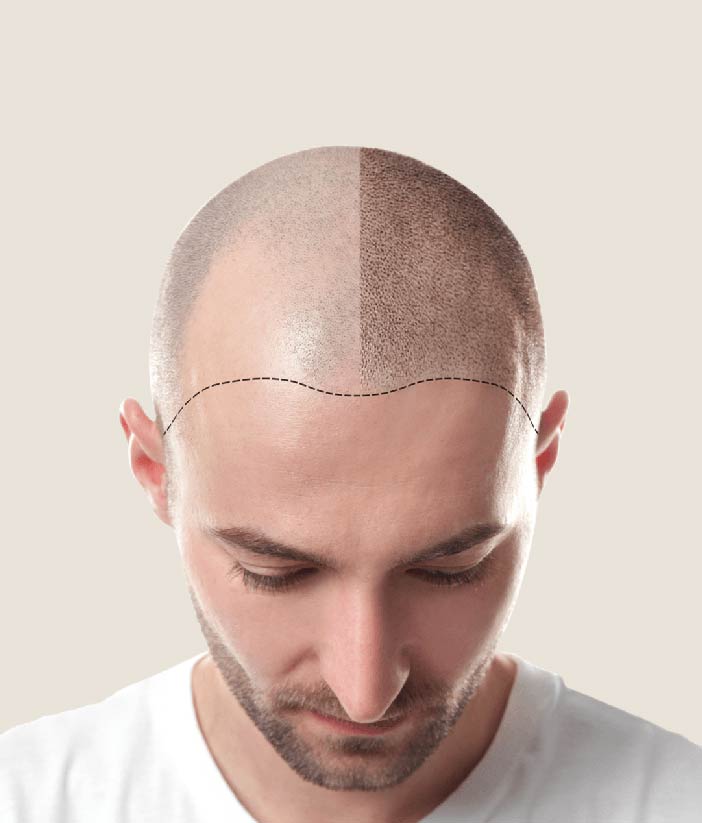 Scalp Micropigmentation : SMP treatment , Benefits ,Before & After