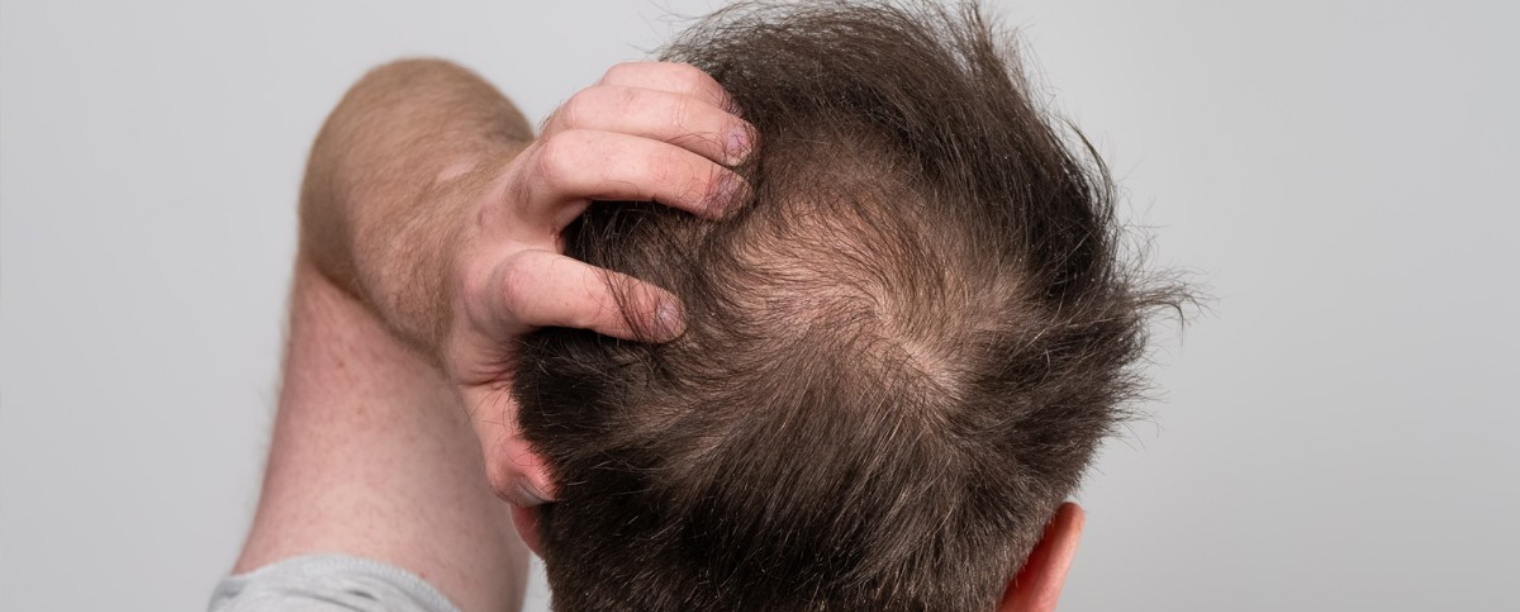 Hair Thinning in Young Adults: Causes, Signs & Hair Care Tips